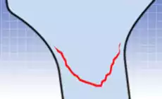 Hiding an "evil smile" peghead break with the Razor Blade Trick - StewMac