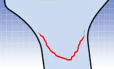 Hiding an "evil smile" peghead break with the Razor Blade Trick - StewMac